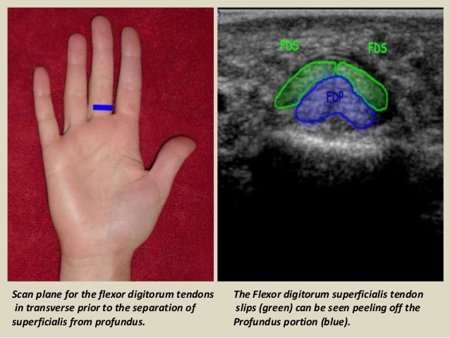 Presentation1.pptx, ultrasound of the hand and fingers.
