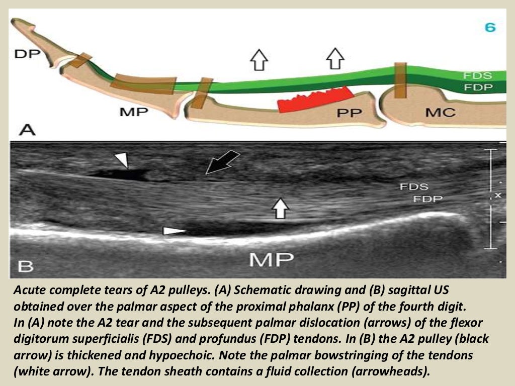 Presentation1.pptx, ultrasound of the hand and fingers.