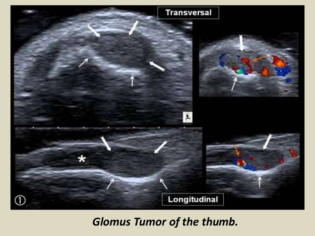 Presentation1.pptx, ultrasound of the hand and fingers.