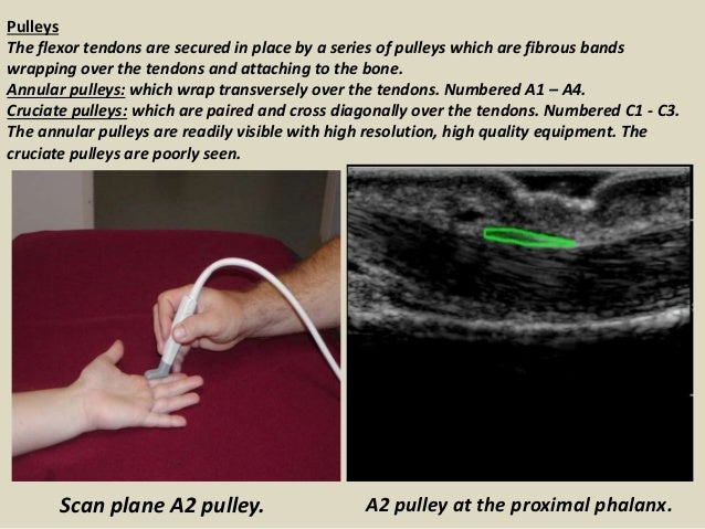 Presentation1.pptx, ultrasound of the hand and fingers.