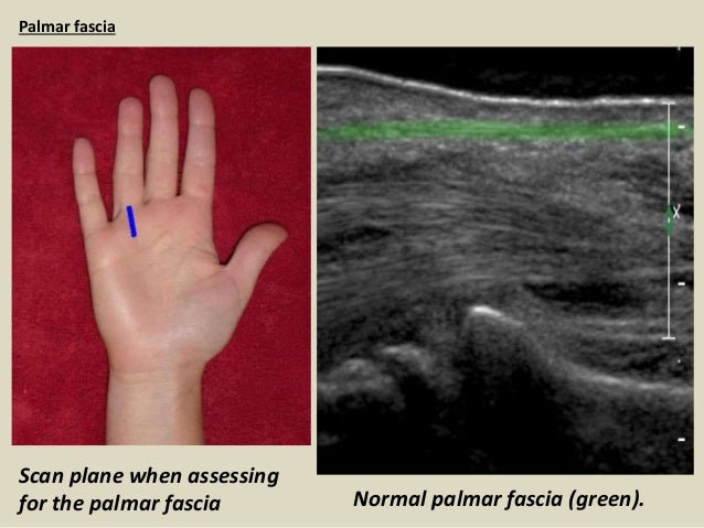 Presentation1.pptx, ultrasound of the hand and fingers.
