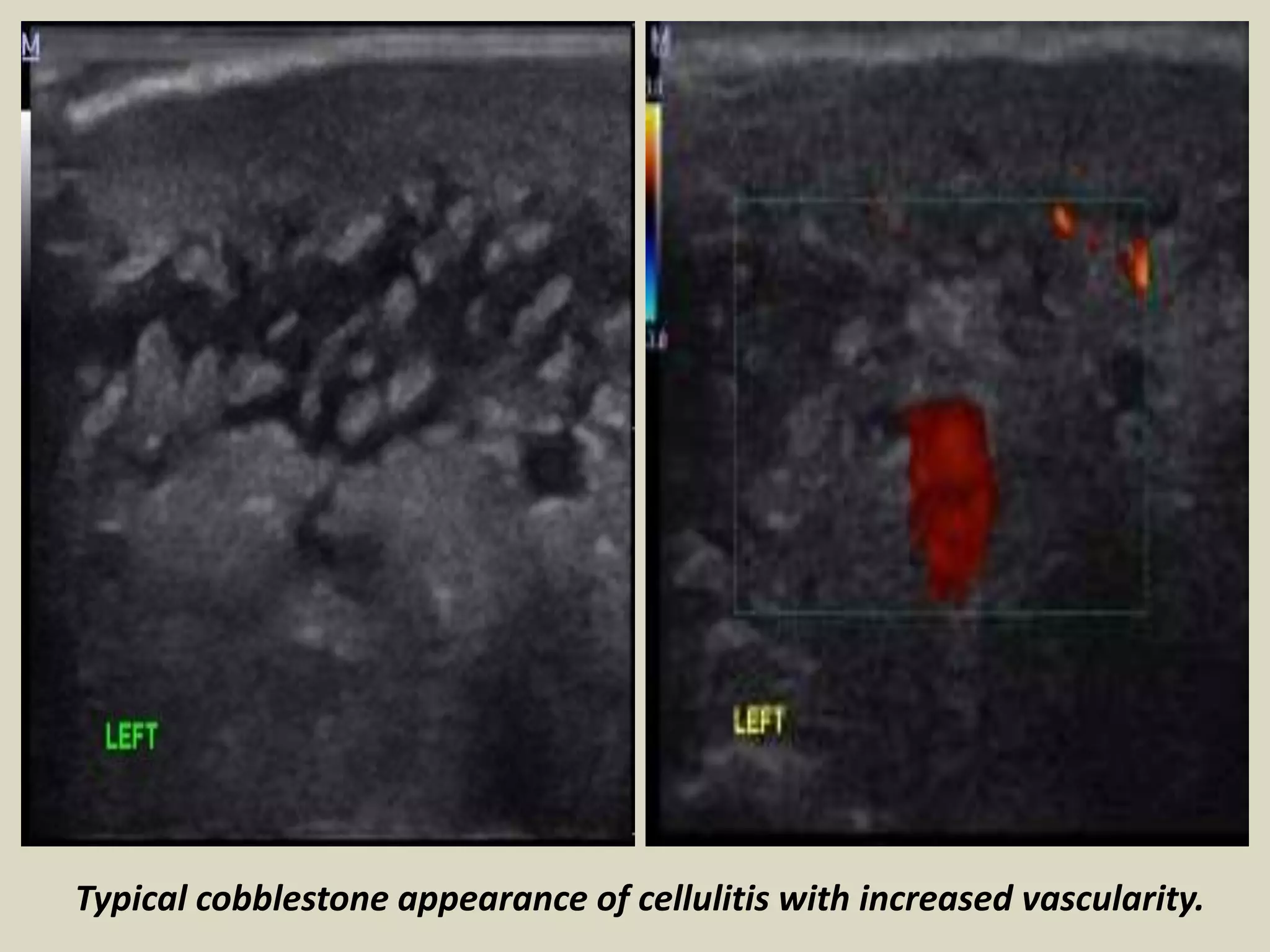 Presentation1.pptx. ultrasound examination of the foot | PPTX