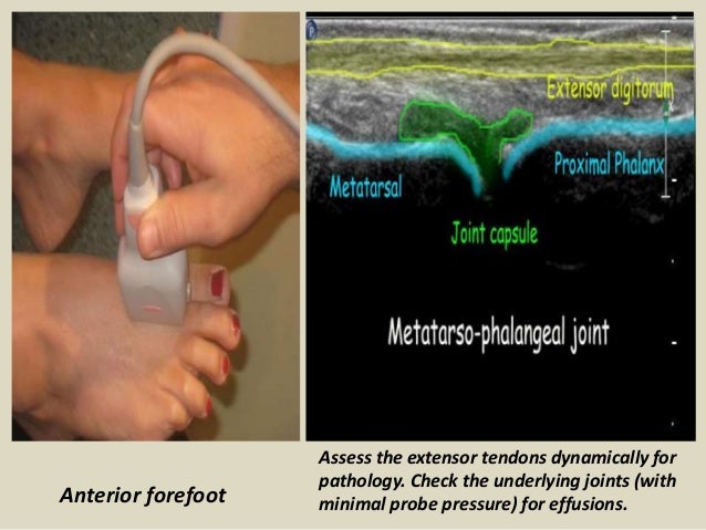 Presentation1.pptx. ultrasound examination of the foot