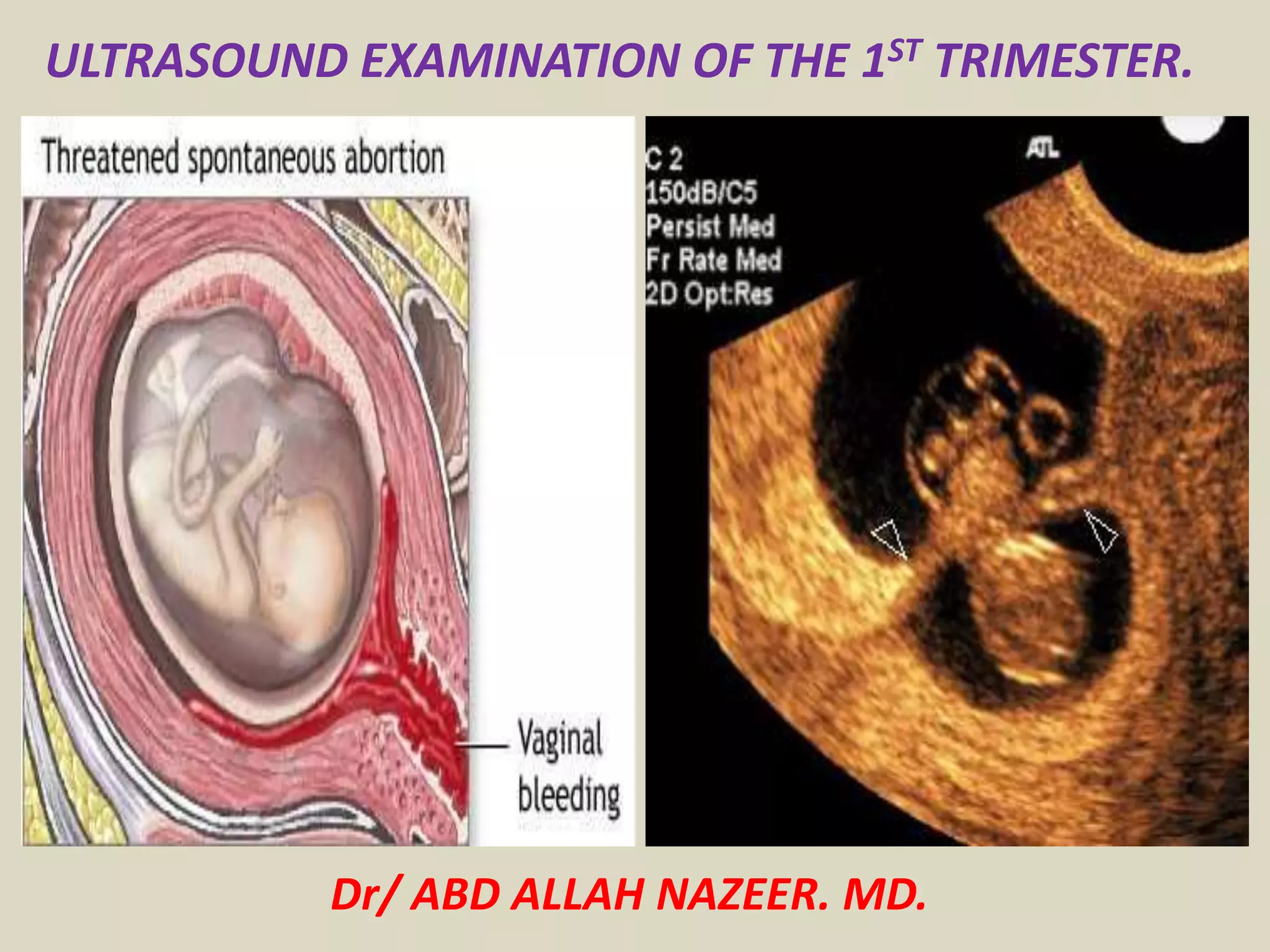 Presentation1.pptx, ultrasound examination of the 1st trimester pregnancy. | PPTX