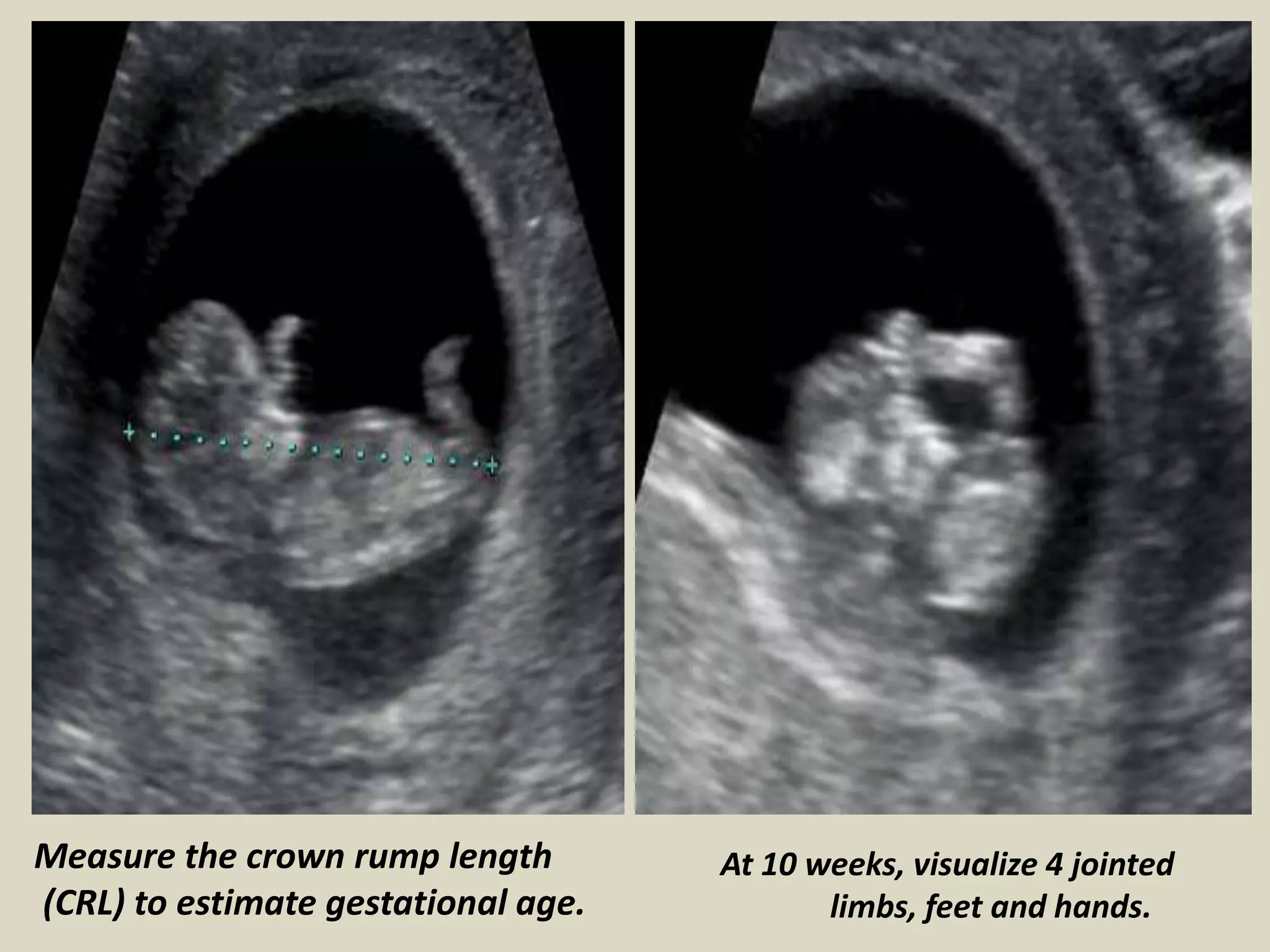 Presentation1.pptx, ultrasound examination of the 1st trimester ...