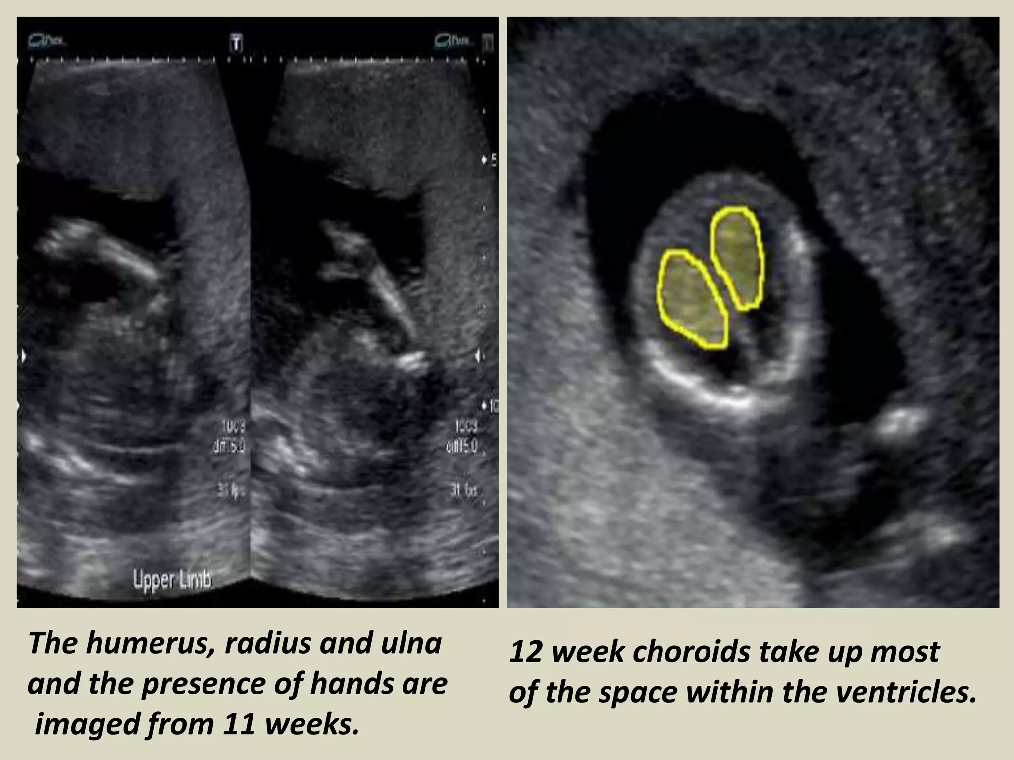 Presentation1.pptx, ultrasound examination of the 1st trimester ...