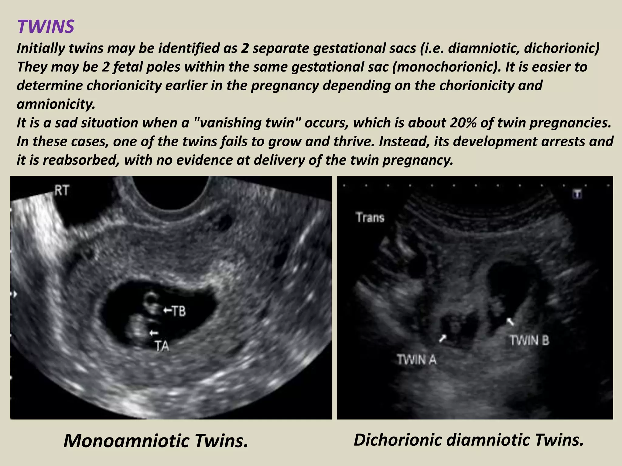 Presentation1.pptx, ultrasound examination of the 1st trimester ...
