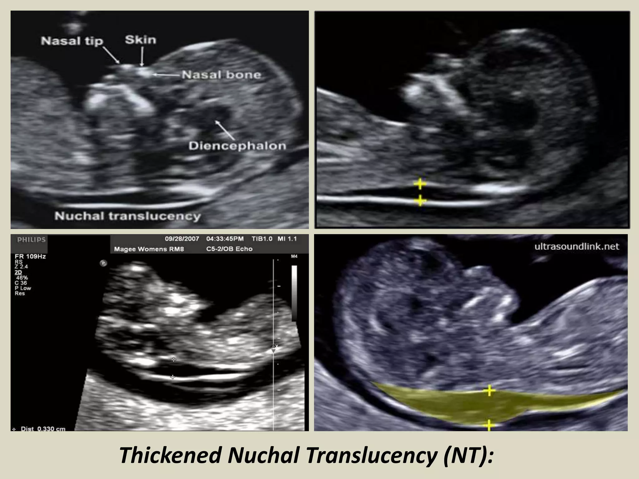 Presentation1.pptx, ultrasound examination of the 1st trimester ...