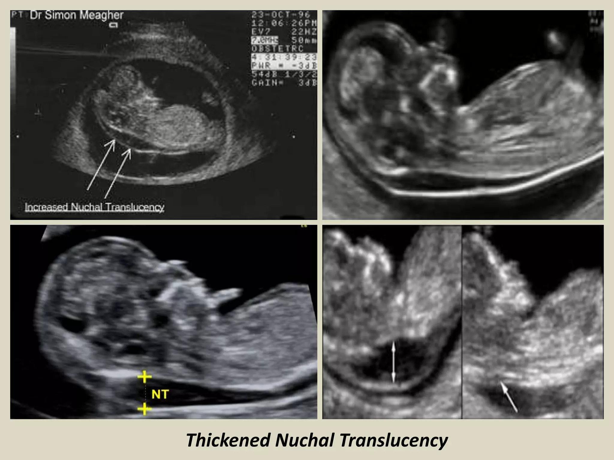 Presentation1.pptx, ultrasound examination of the 1st trimester ...