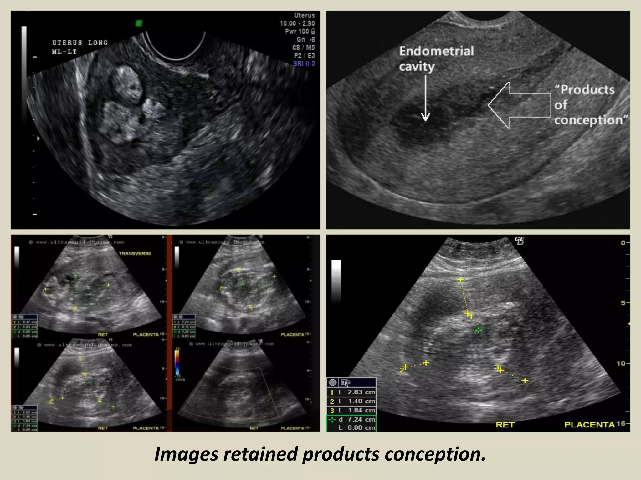 Presentation1.pptx, ultrasound examination of the 1st trimester pregnancy. | PPTX