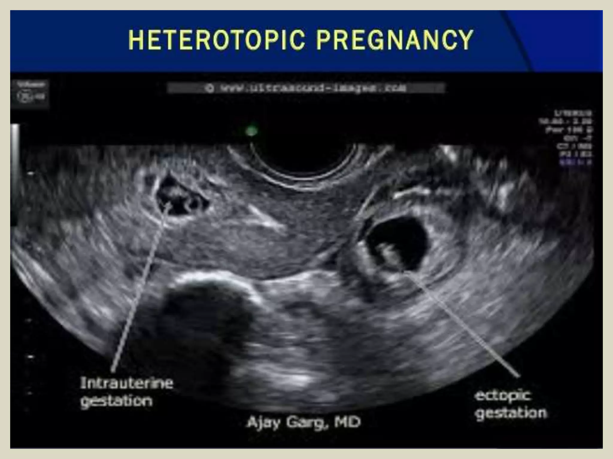 Presentation1.pptx, ultrasound examination of the 1st trimester ...