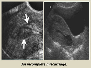 Presentation1.pptx, ultrasound examination of the 1st trimester ...