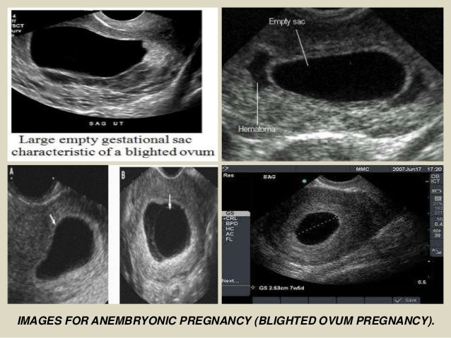 Presentation1.pptx, ultrasound examination of the 1st trimester pregn…