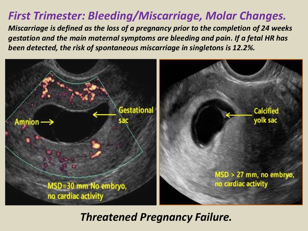 Presentation1.pptx, ultrasound examination of the 1st trimester pregn…