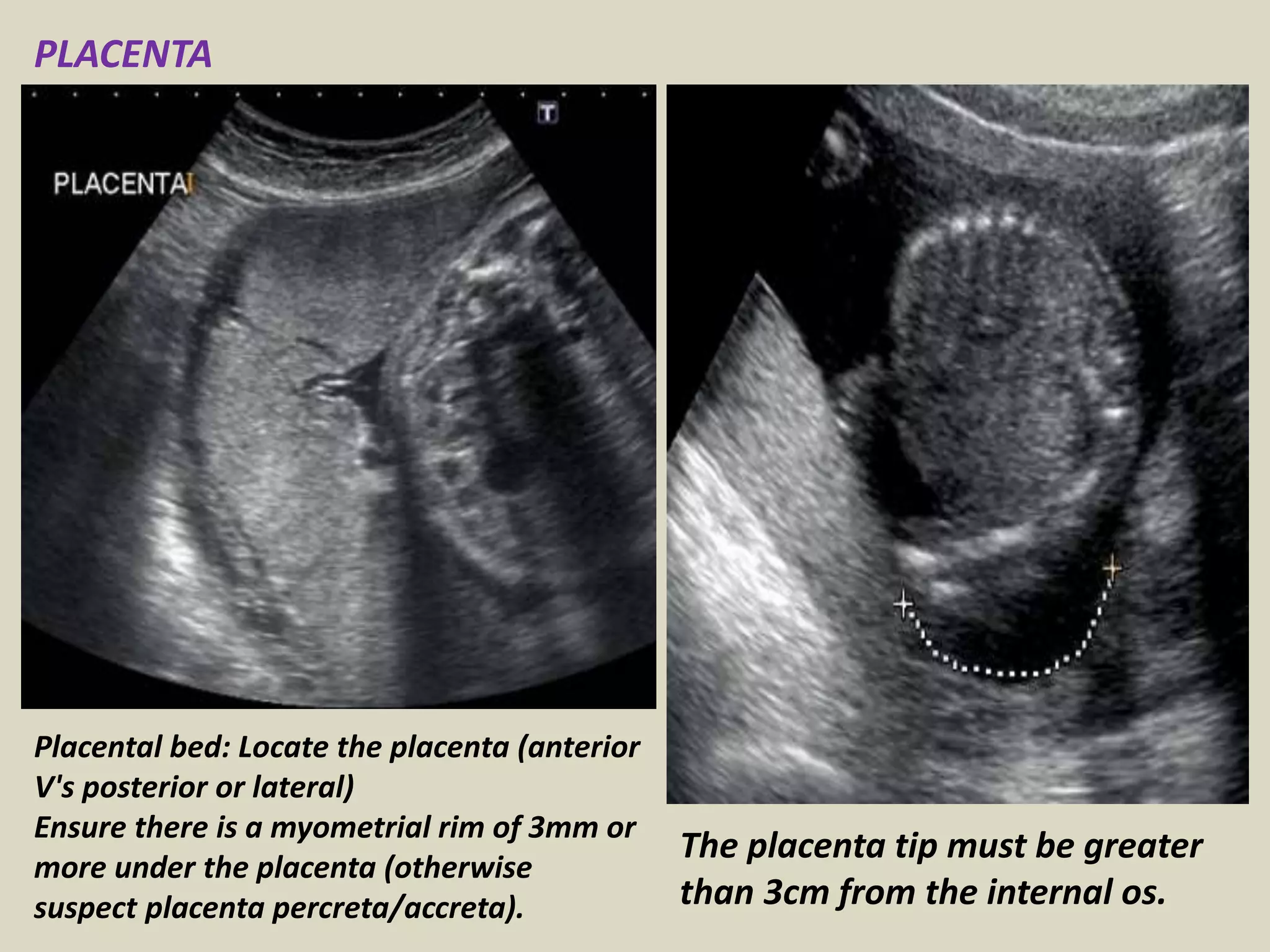 Presentation1.pptx, ultrasound examination of the 2nd & 3rd trimester ...