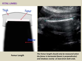 Presentation1.pptx, ultrasound examination of the 2nd & 3rd trimester ...