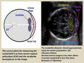 Presentation1.pptx, ultrasound examination of the 2nd & 3rd trimester ...