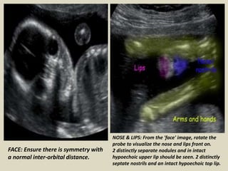 Presentation1.pptx, ultrasound examination of the 2nd & 3rd trimester ...