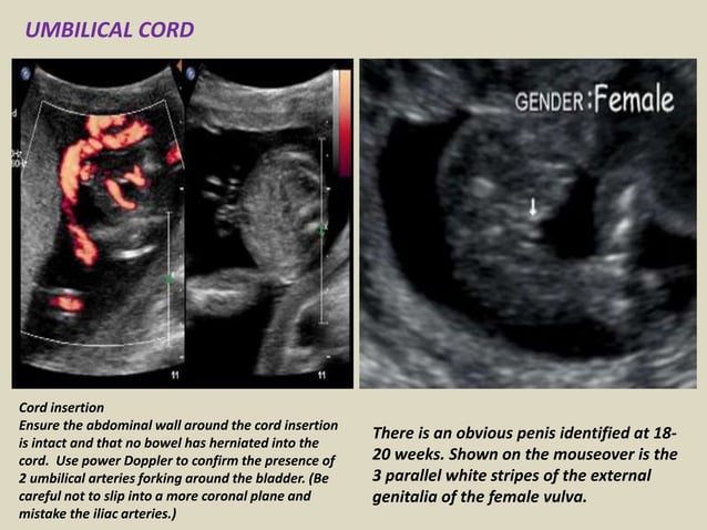 Presentation1 Pptx Ultrasound Examination Of The 2nd And 3rd Trimester