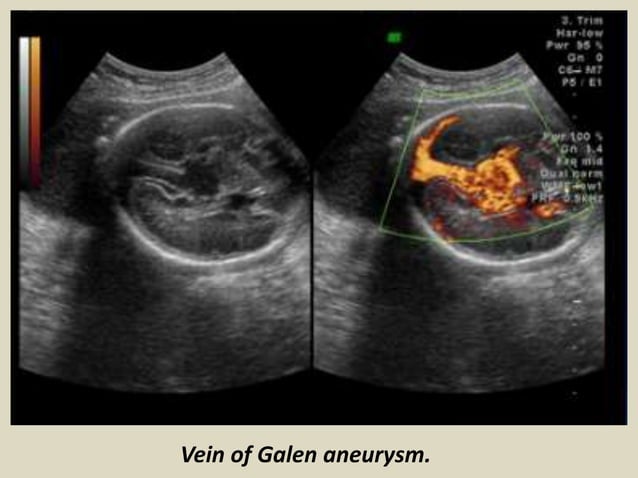 Presentation1 Pptx Ultrasound Examination Of The 2nd And 3rd Trimester