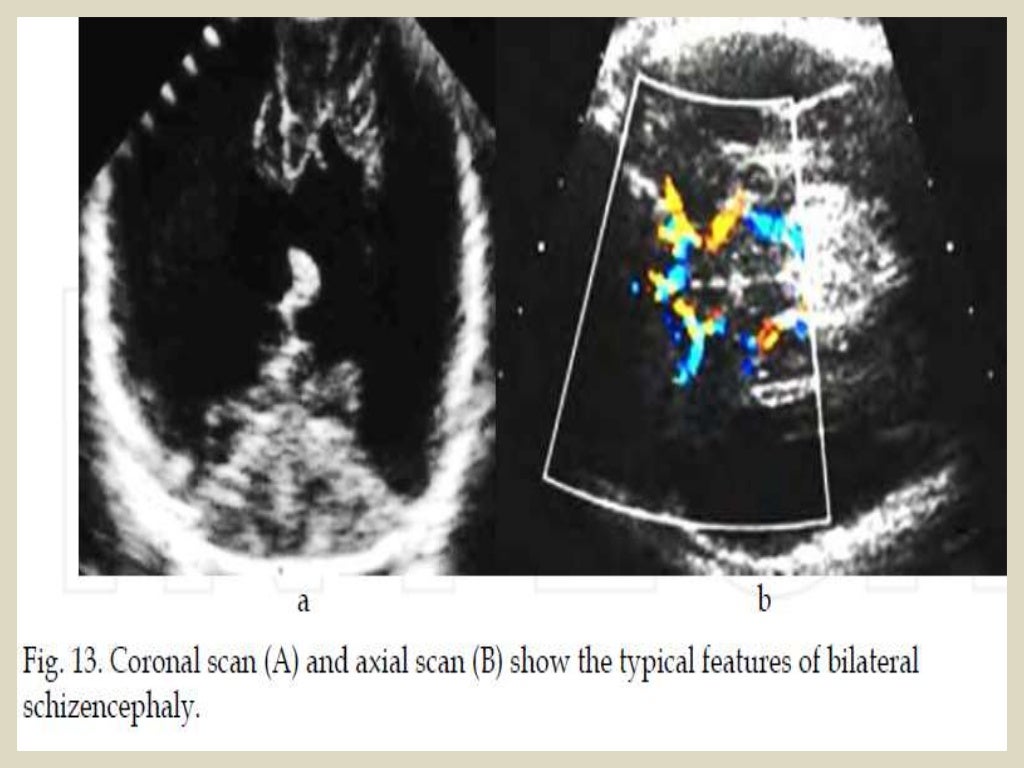 Presentation1 Pptx Ultrasound Examination Of The 2nd And 3rd Trimester…