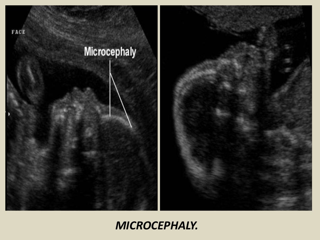 Presentation1 Pptx Ultrasound Examination Of The 2nd And 3rd Trimester…