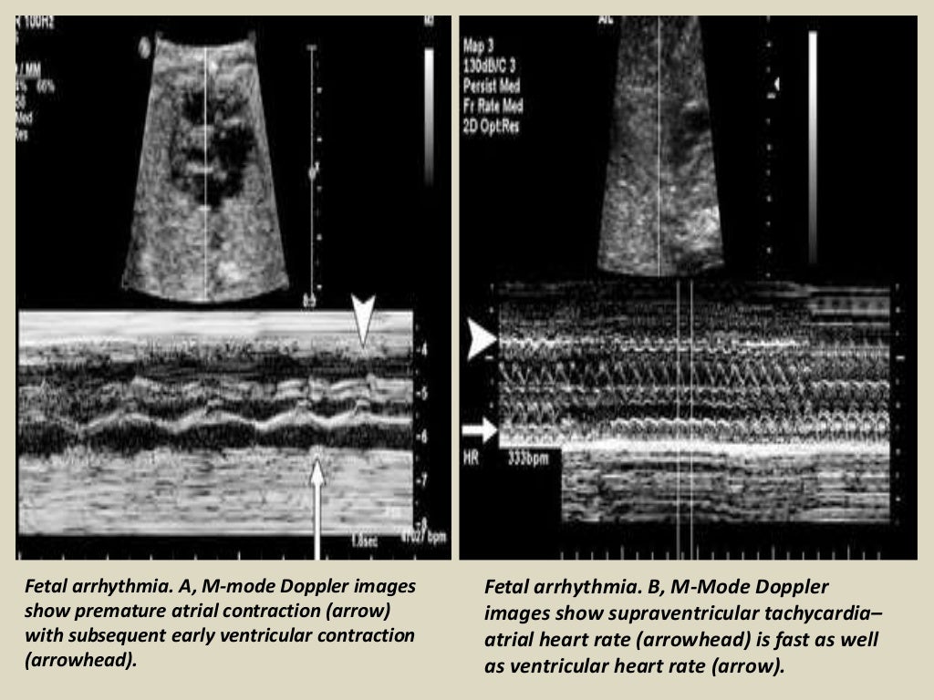 Presentation1 Pptx Ultrasound Examination Of The 2nd And 3rd Trimester…
