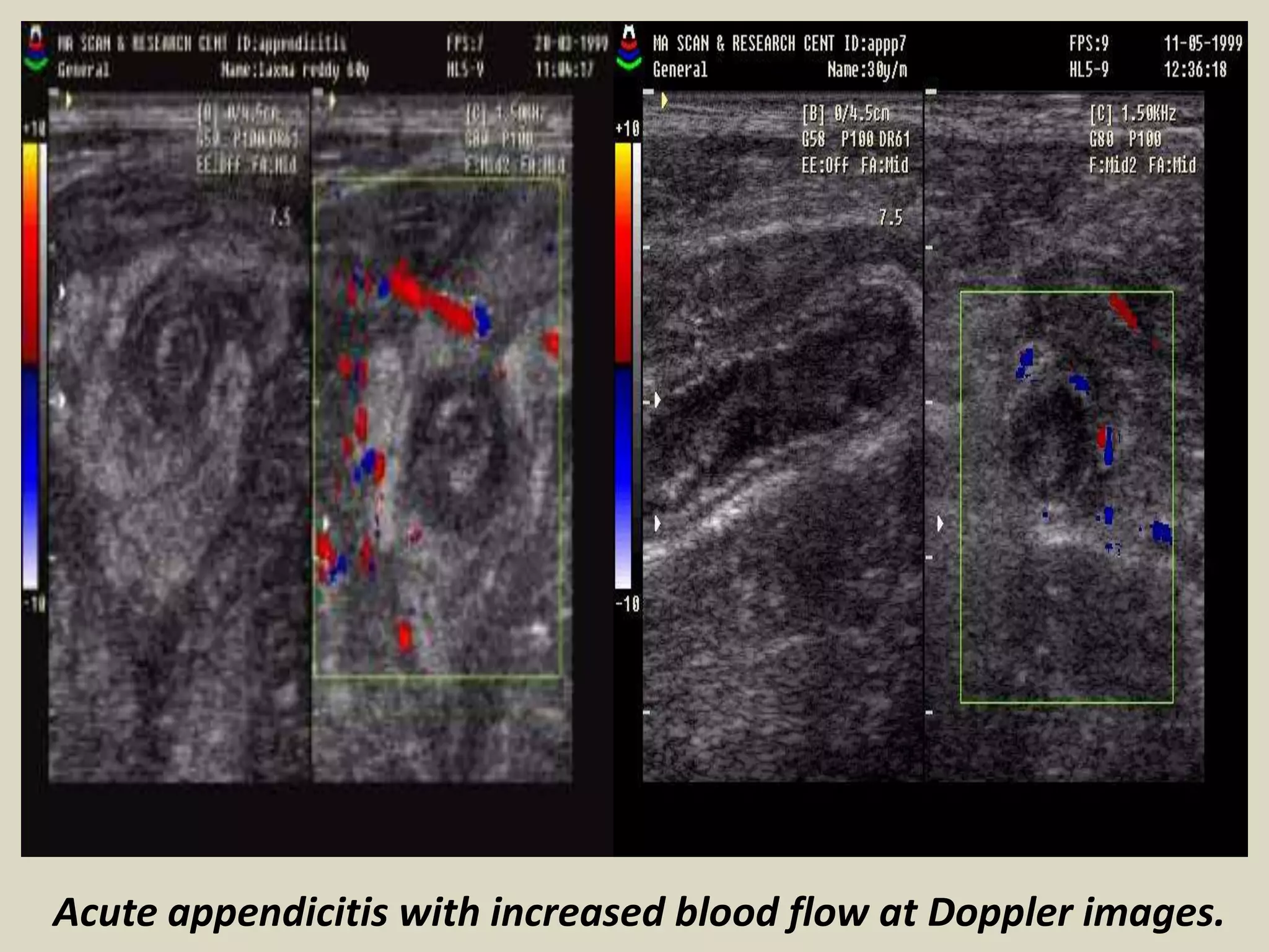 Presentation1.pptx, ultrasound examination of the appendix. | PPTX