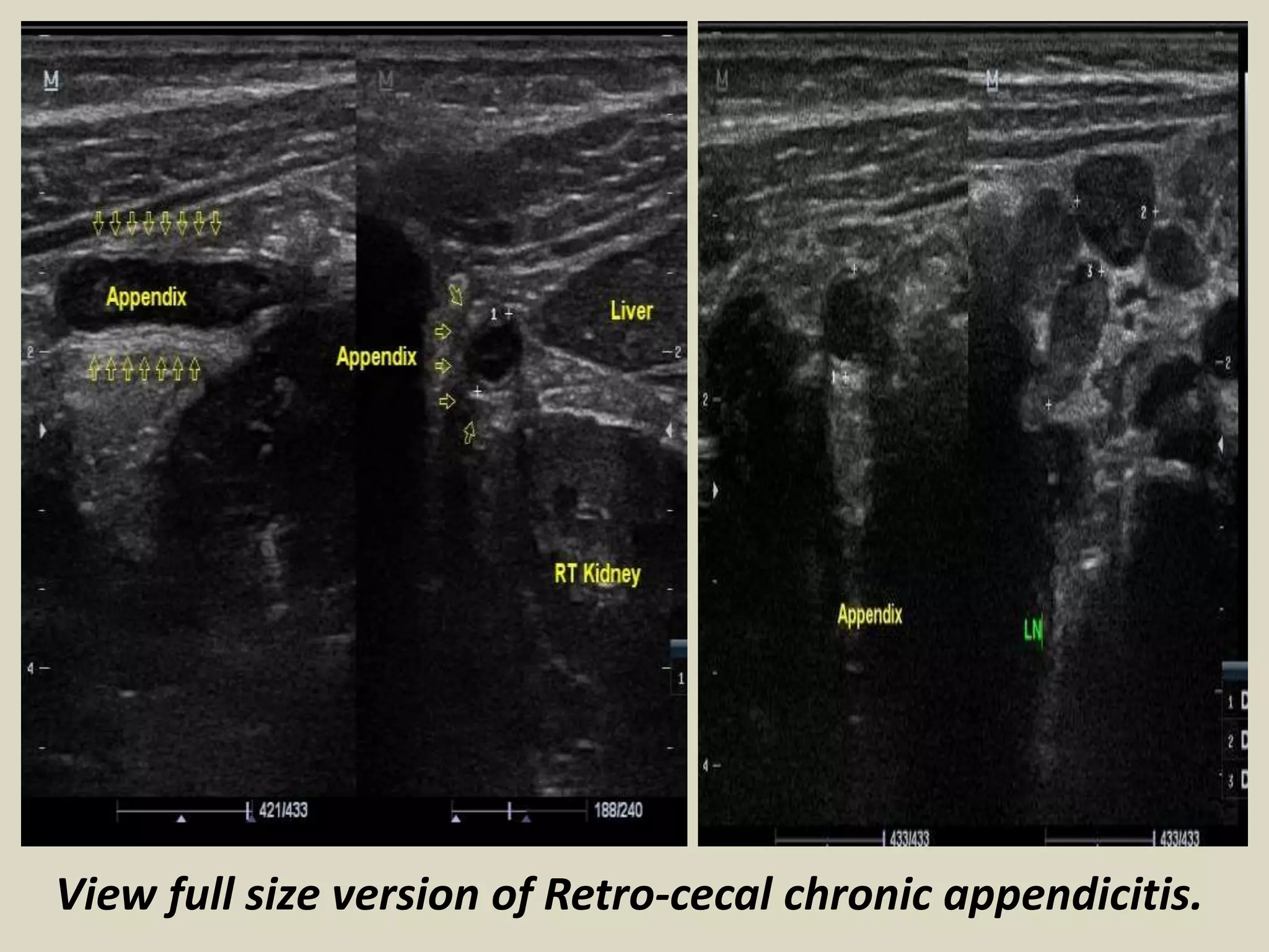 Presentation1.pptx, ultrasound examination of the appendix. | PPTX