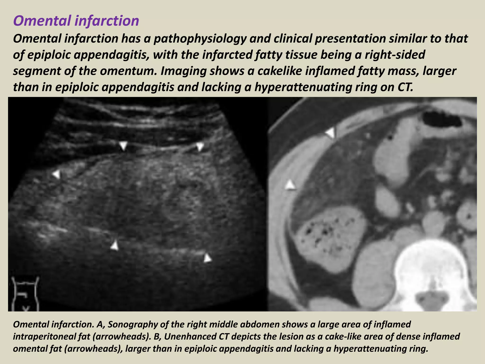 Presentation1.pptx, ultrasound examination of the appendix. | PPTX