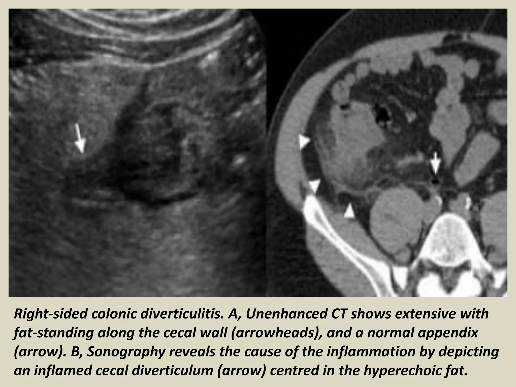 Presentation1.pptx, ultrasound examination of the appendix. | PPTX