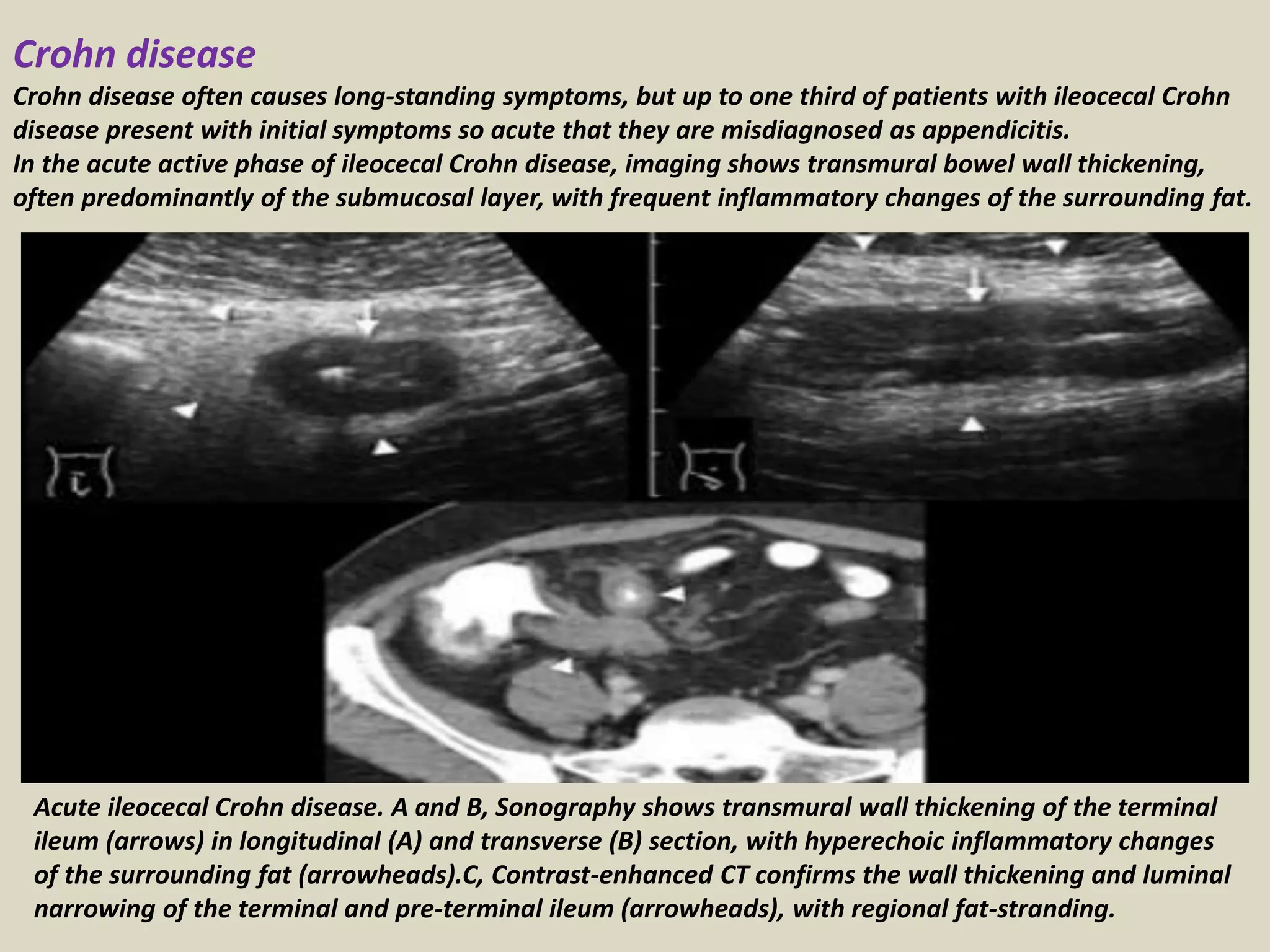 Presentation1.pptx, ultrasound examination of the appendix. | PPTX