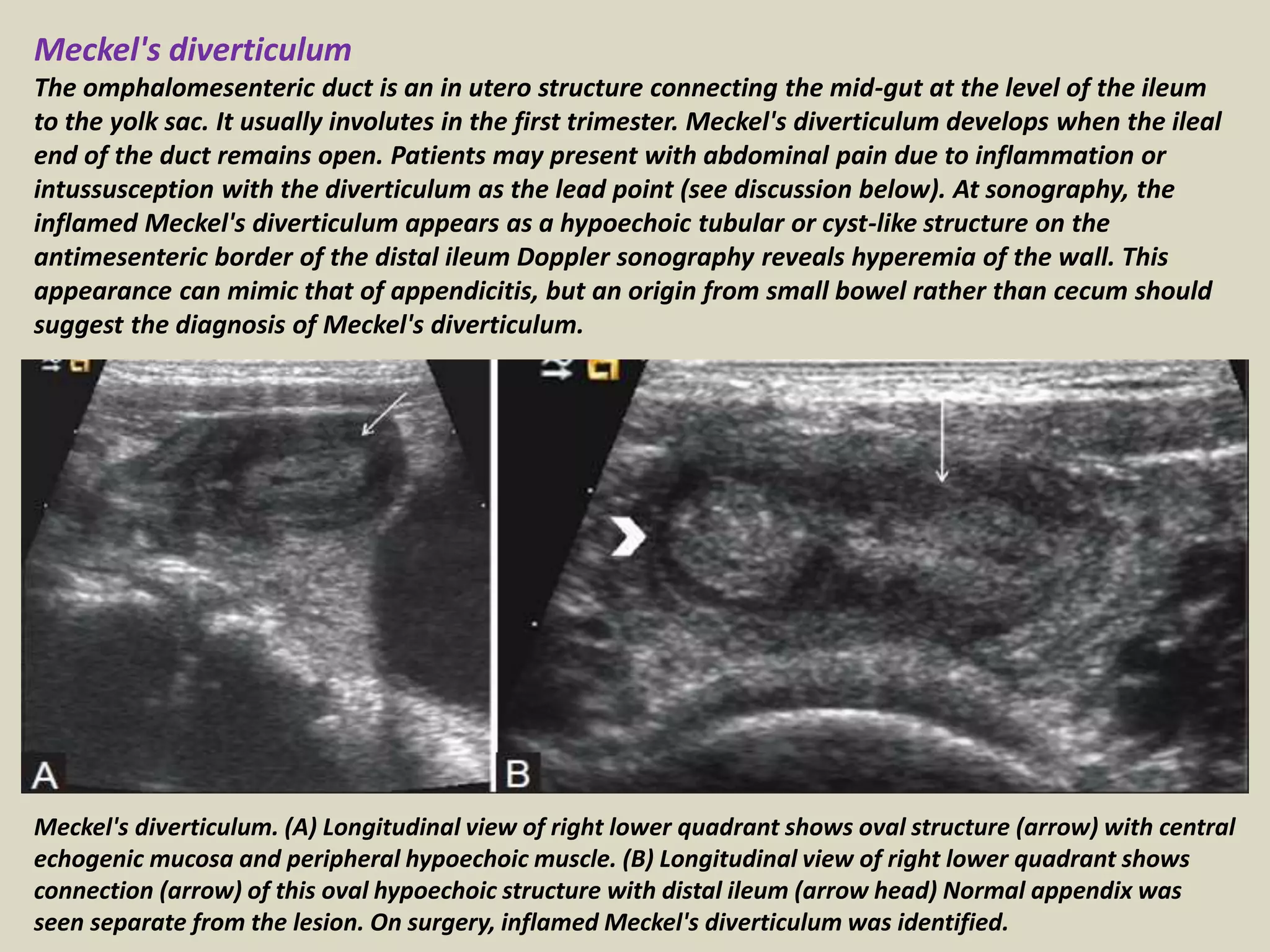 Presentation1.pptx, ultrasound examination of the appendix. | PPTX
