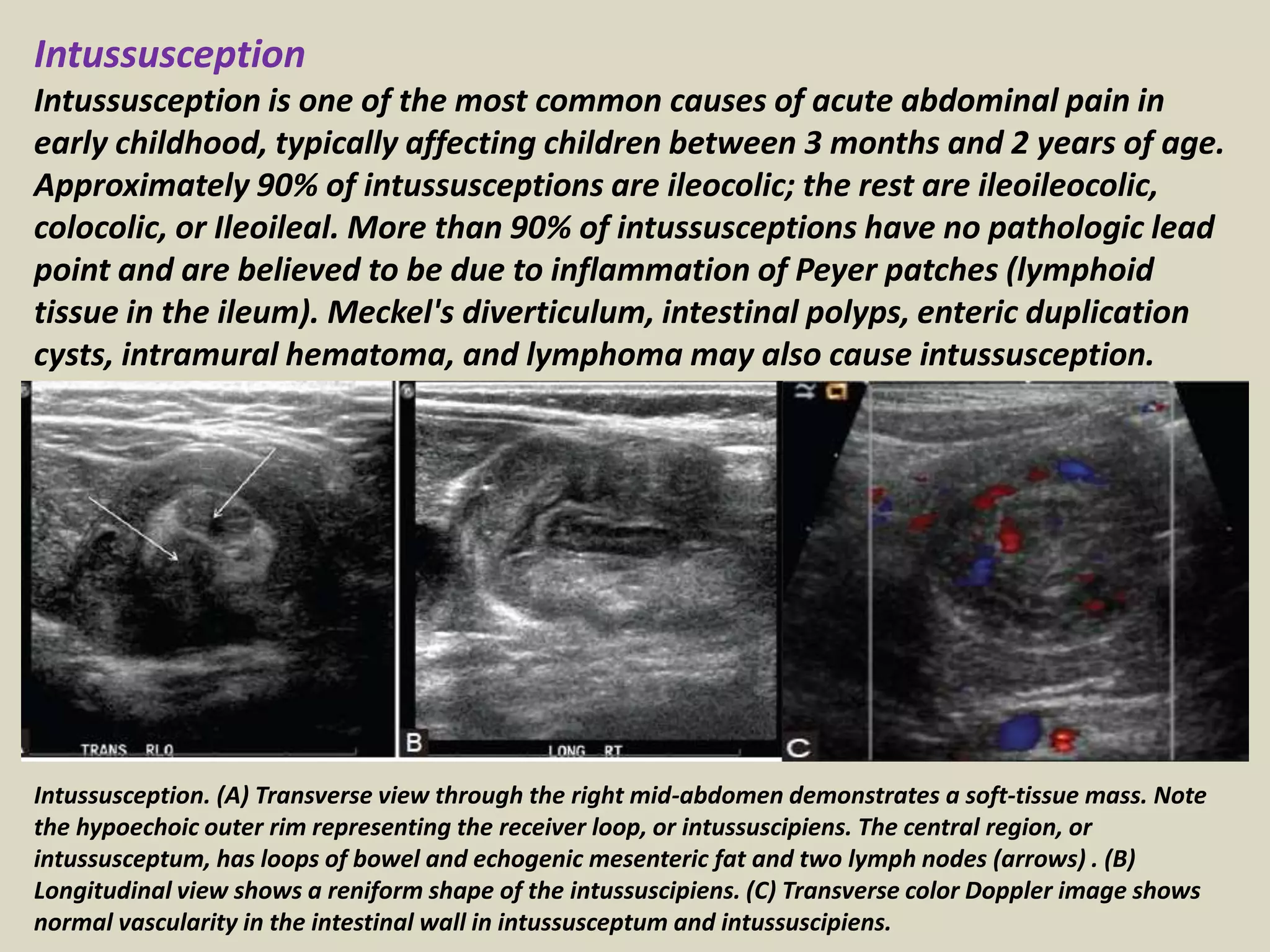Presentation1.pptx, ultrasound examination of the appendix. | PPTX