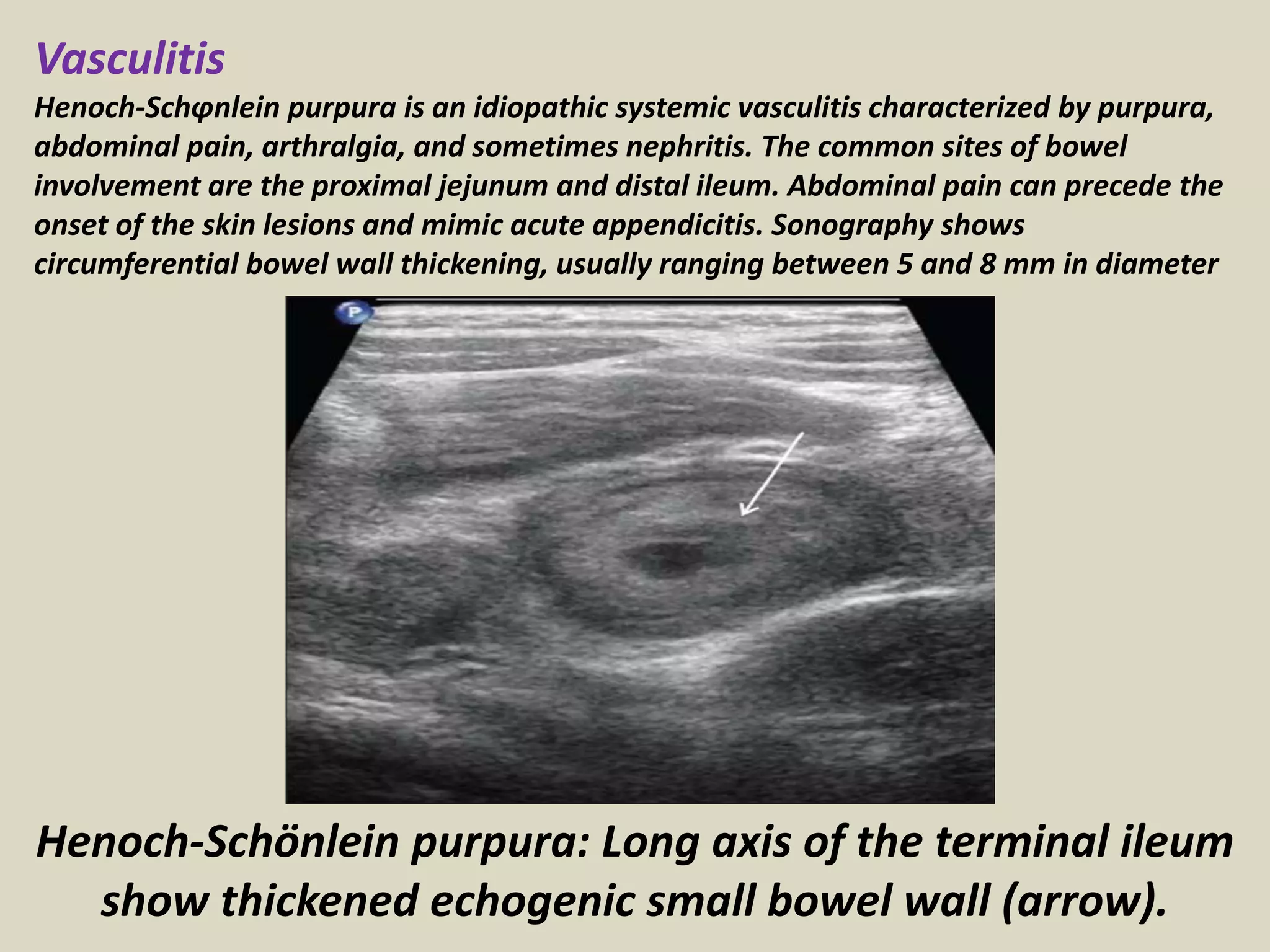 Presentation1.pptx, ultrasound examination of the appendix. | PPTX