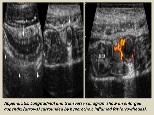 Presentation1.pptx, ultrasound examination of the appendix. | PPTX