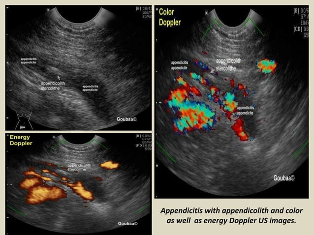 Presentation1.pptx, ultrasound examination of the appendix. | PPTX
