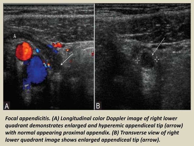 Presentation1.pptx, ultrasound examination of the appendix. | PPTX