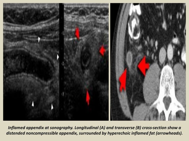 Presentation1.pptx, ultrasound examination of the appendix. | PPTX
