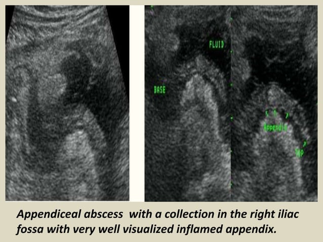 Presentation1.pptx, ultrasound examination of the appendix. | PPTX