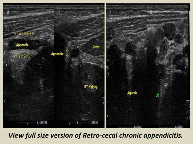 Presentation1.pptx, ultrasound examination of the appendix. | PPTX
