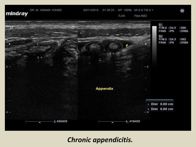 Presentation1.pptx, ultrasound examination of the appendix. | PPTX