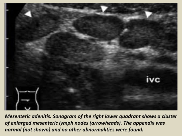 Presentation1.pptx, ultrasound examination of the appendix. | PPTX