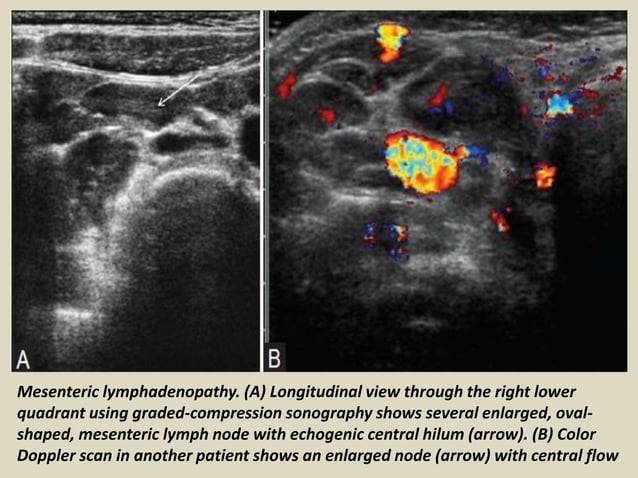 Presentation1.pptx, ultrasound examination of the appendix. | PPTX