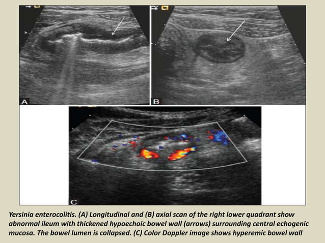 Presentation1.pptx, ultrasound examination of the appendix. | PPTX