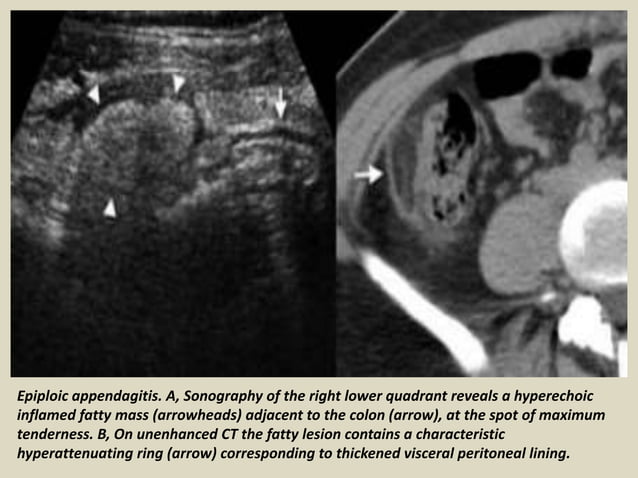 Presentation1.pptx, ultrasound examination of the appendix. | PPTX