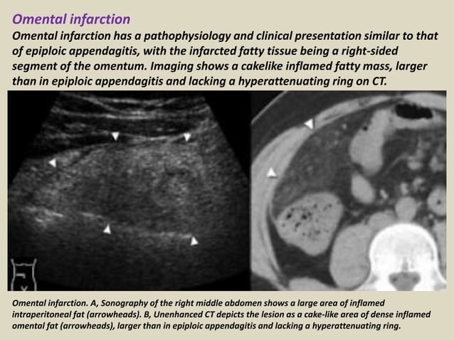 Presentation1.pptx, ultrasound examination of the appendix. | PPTX