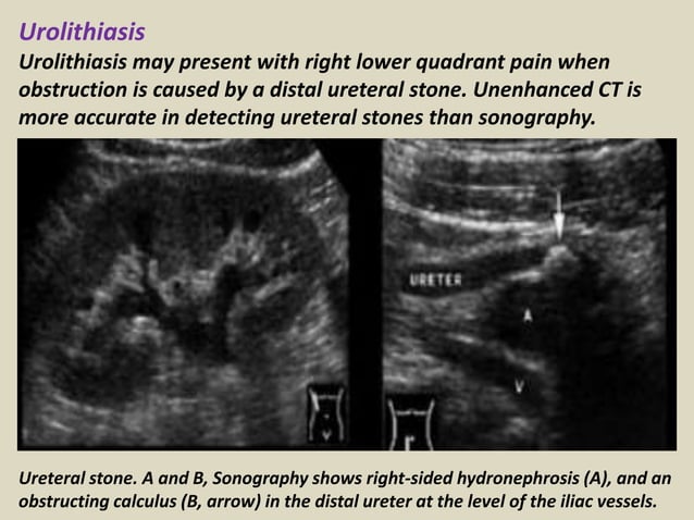 Presentation1.pptx, ultrasound examination of the appendix. | PPTX