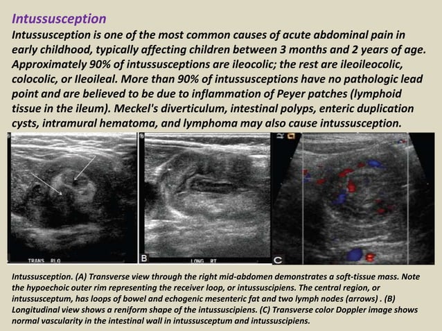 Presentation1.pptx, ultrasound examination of the appendix. | PPTX