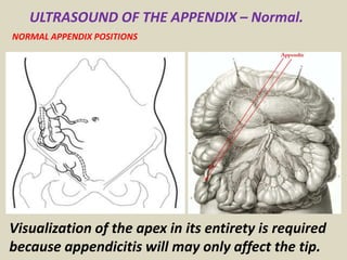 Presentation1.pptx, ultrasound examination of the appendix. | PPTX